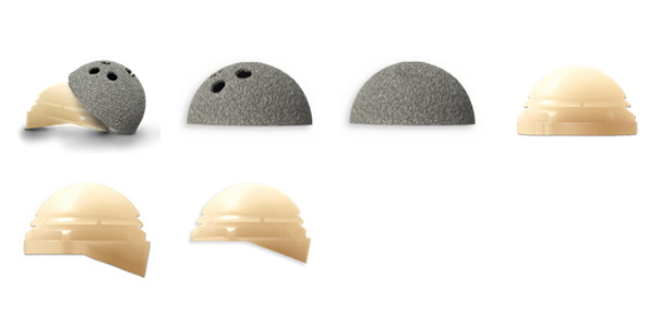 Consensus Orthopedics присоединяется к проекту Materialise